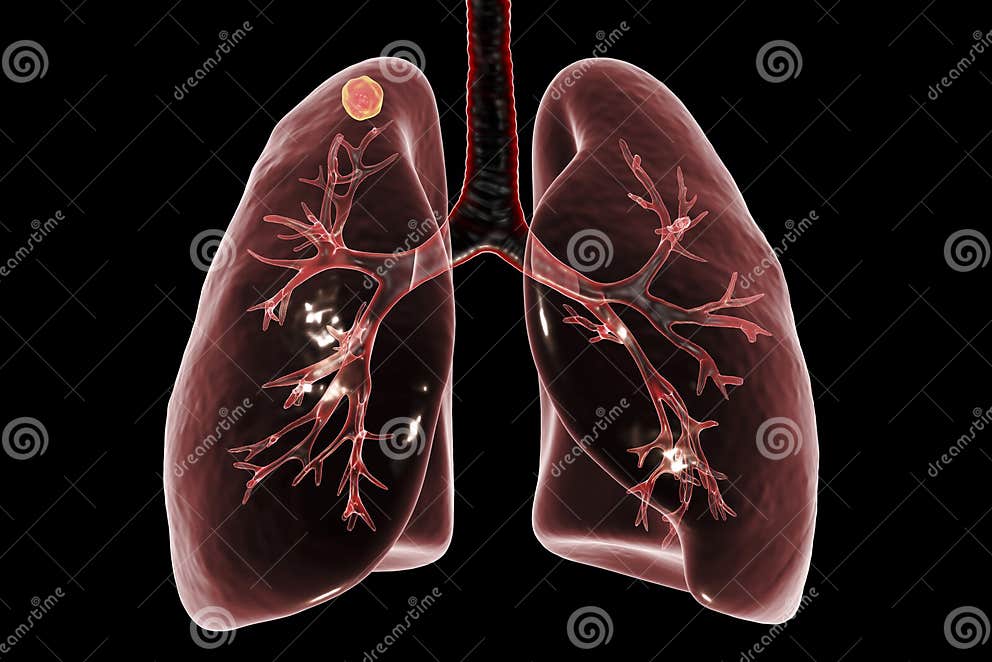 Secondary Tuberculosis in Lungs Stock Illustration - Illustration of ...