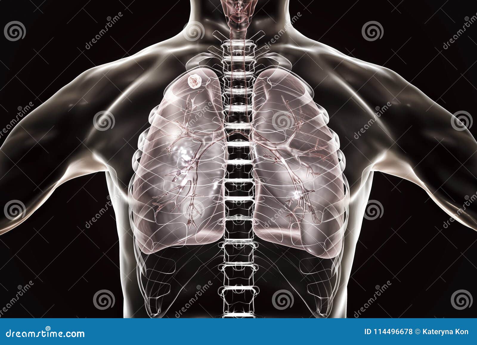 Secondary Tuberculosis in Lungs Stock Illustration - Illustration of ...