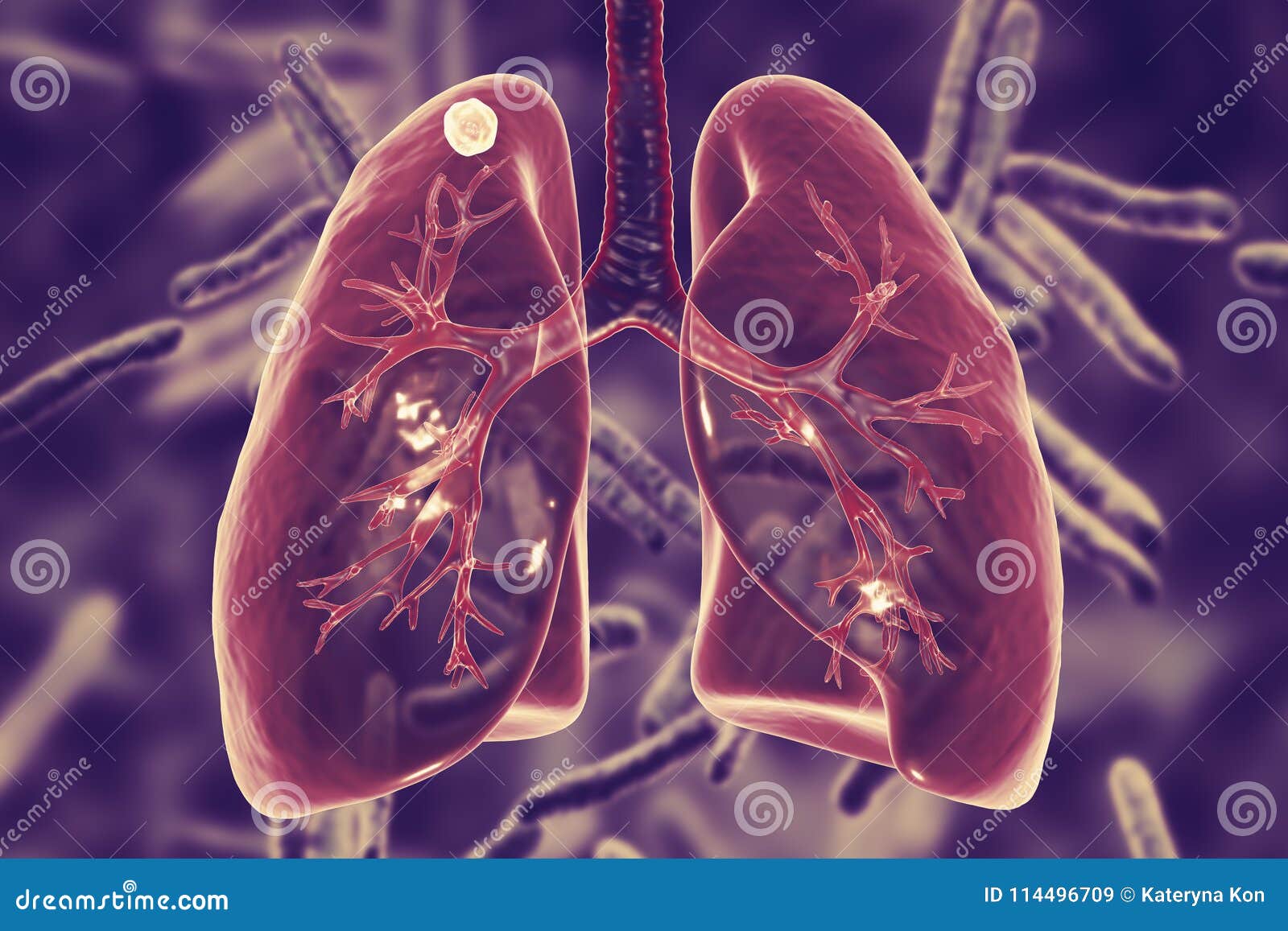 Secondary Tuberculosis in Lungs Stock Illustration - Illustration of ...