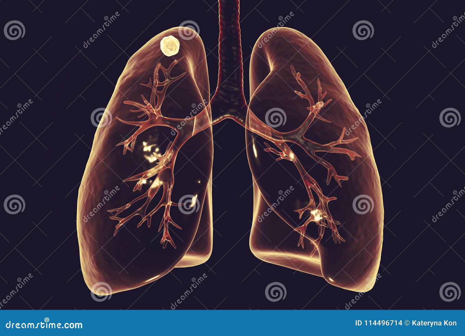 Secondary Tuberculosis in Lungs Stock Illustration - Illustration of ...