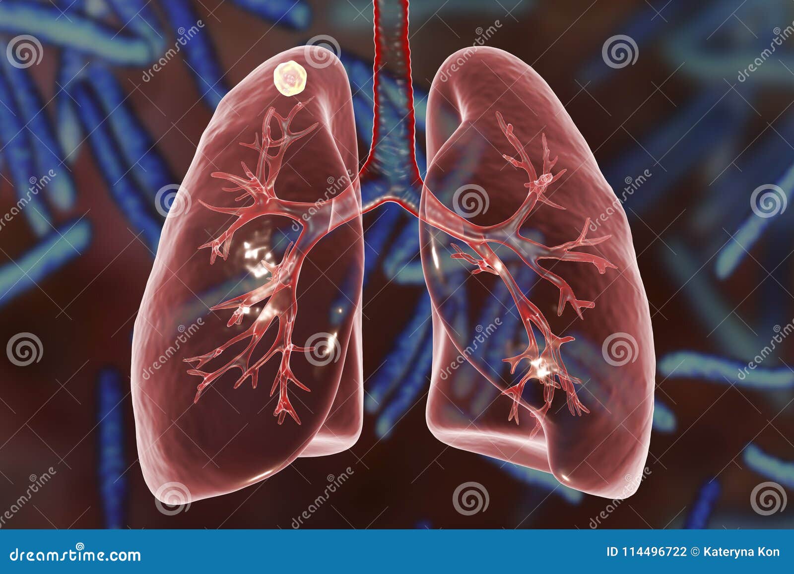 Secondary Tuberculosis in Lungs Stock Illustration - Illustration of ...