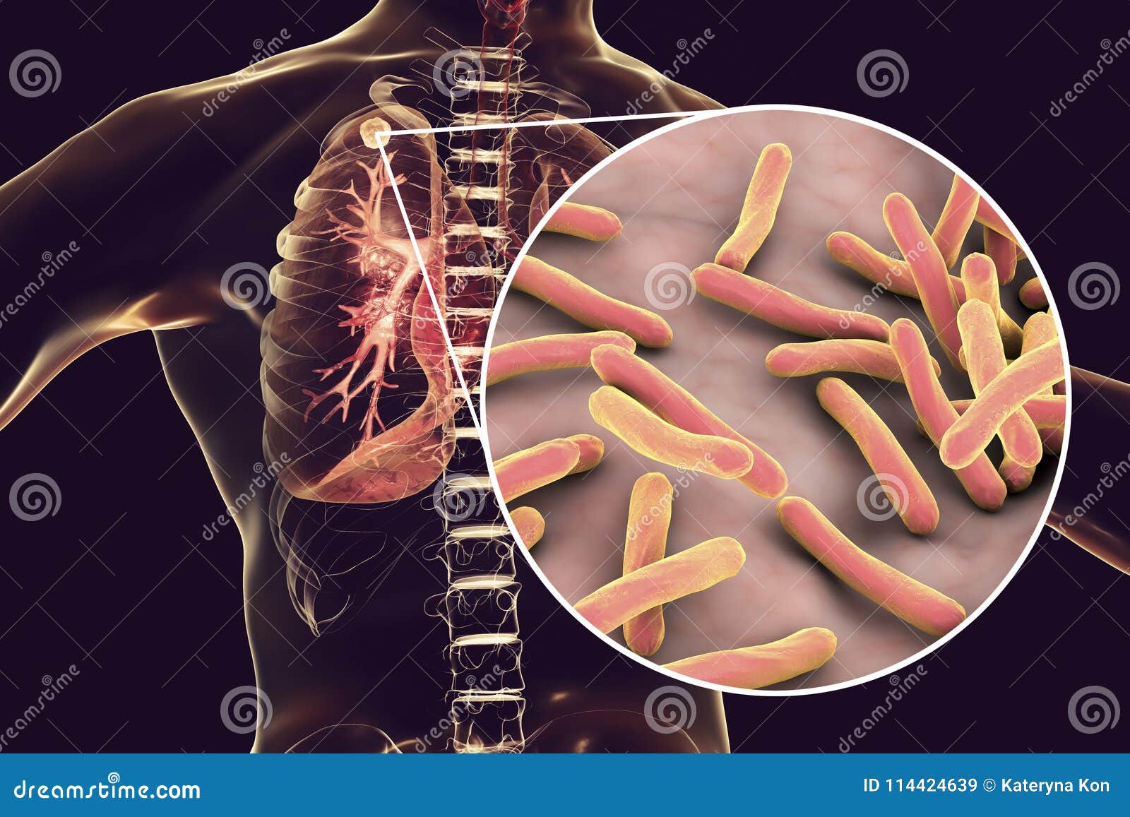 Secondary Tuberculosis in Lungs and Close-up View of Mycobacterium ...
