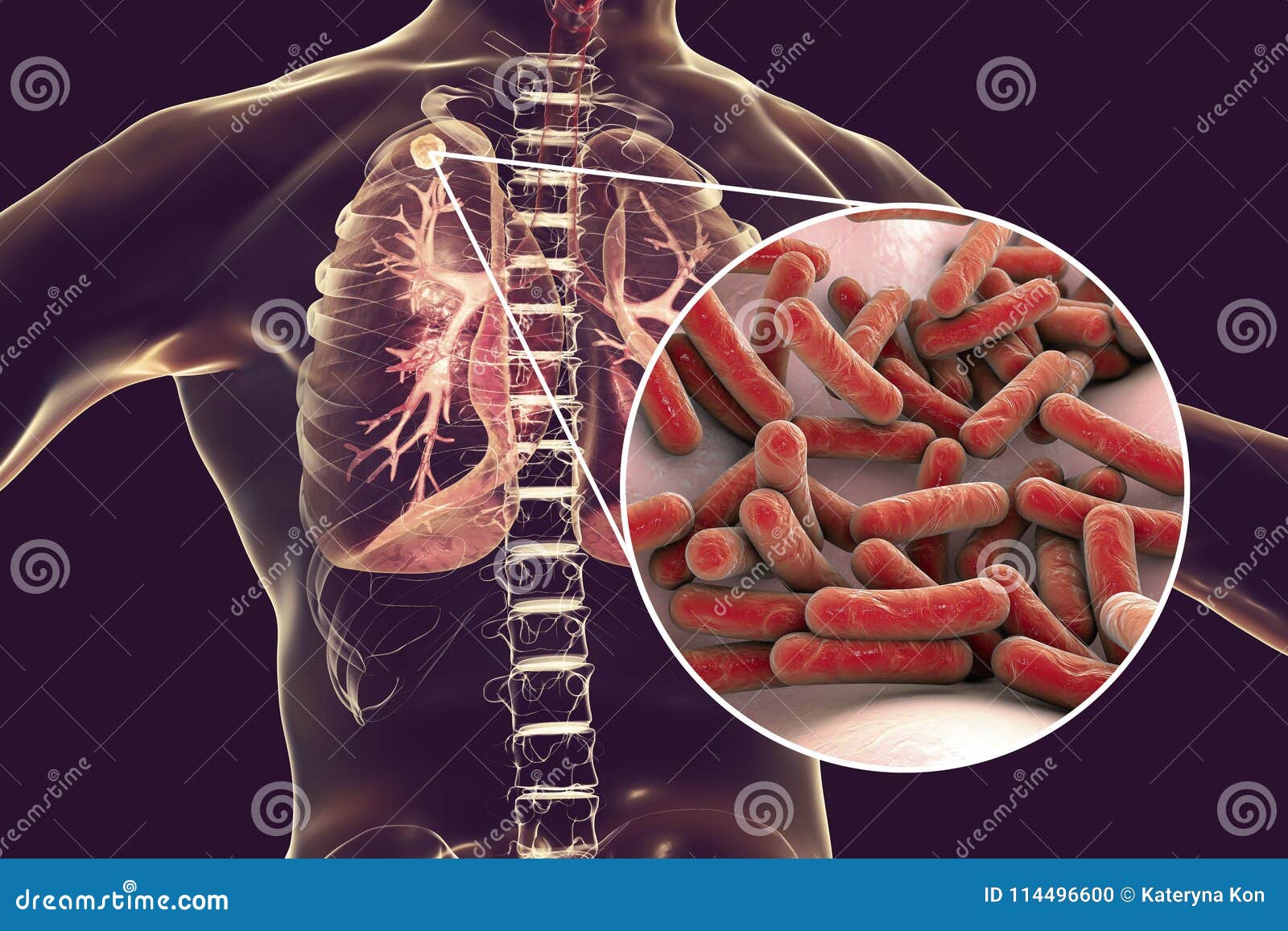 Secondary Tuberculosis in Lungs and Close-up View of Mycobacterium ...