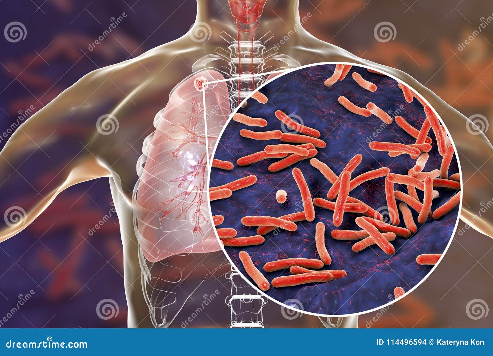 Secondary Tuberculosis In Lungs And Close-up View Of Mycobacterium ...