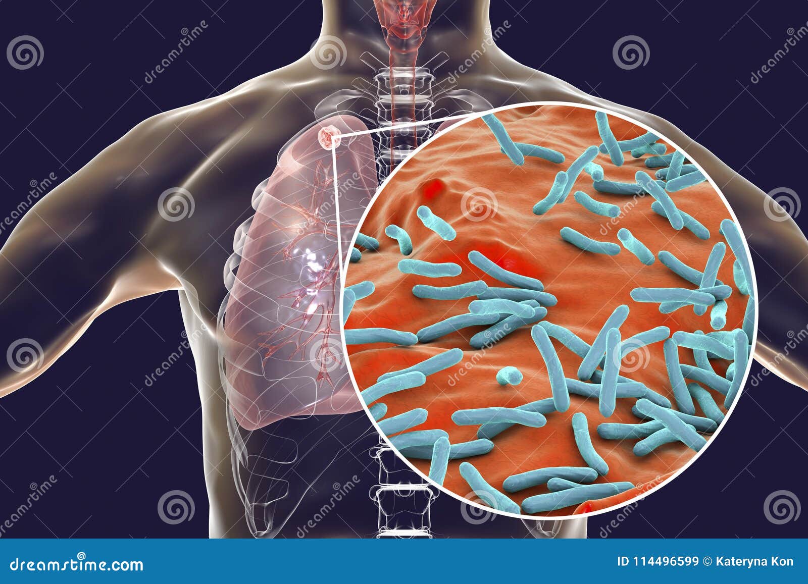Secondary Tuberculosis in Lungs and Close-up View of Mycobacterium ...