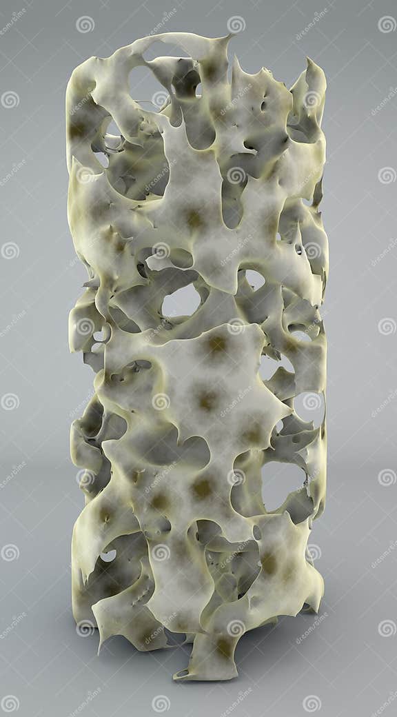 Section of Bone with Osteoporosis Stock Illustration - Illustration of ...