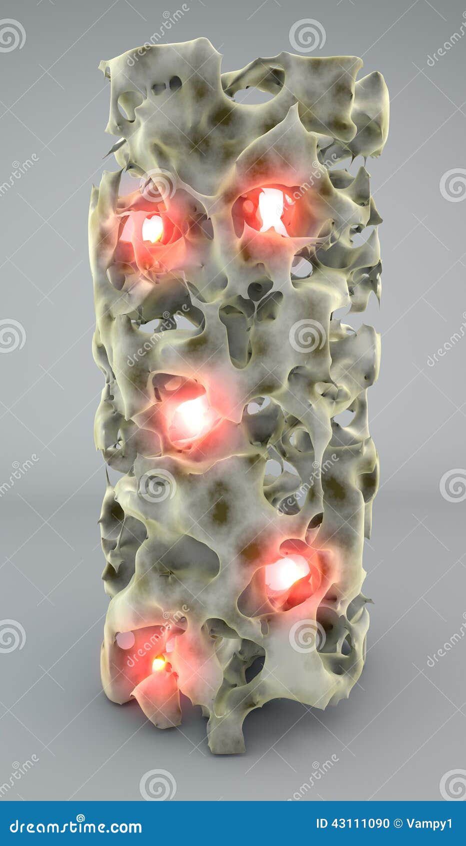 Section of Bone with Osteoporosis Stock Illustration - Illustration of ...