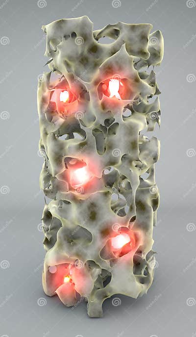 Section of Bone with Osteoporosis Stock Illustration - Illustration of ...
