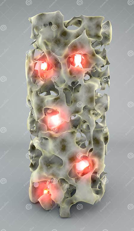 Section of Bone with Osteoporosis Stock Illustration - Illustration of ...