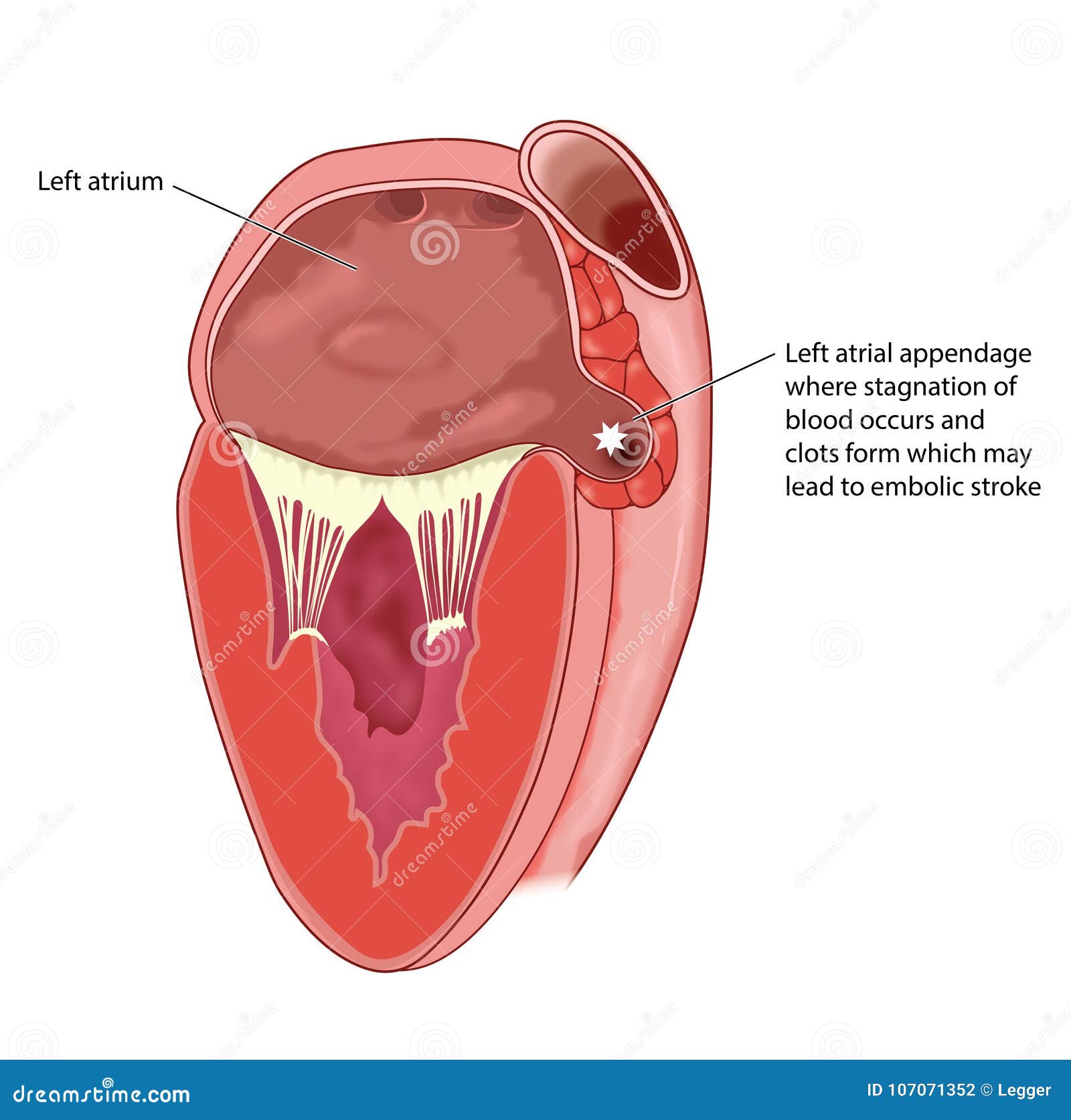 Heart Left Atrial Appendage Stock Vector Illustration Of Clot Appendage 107071352