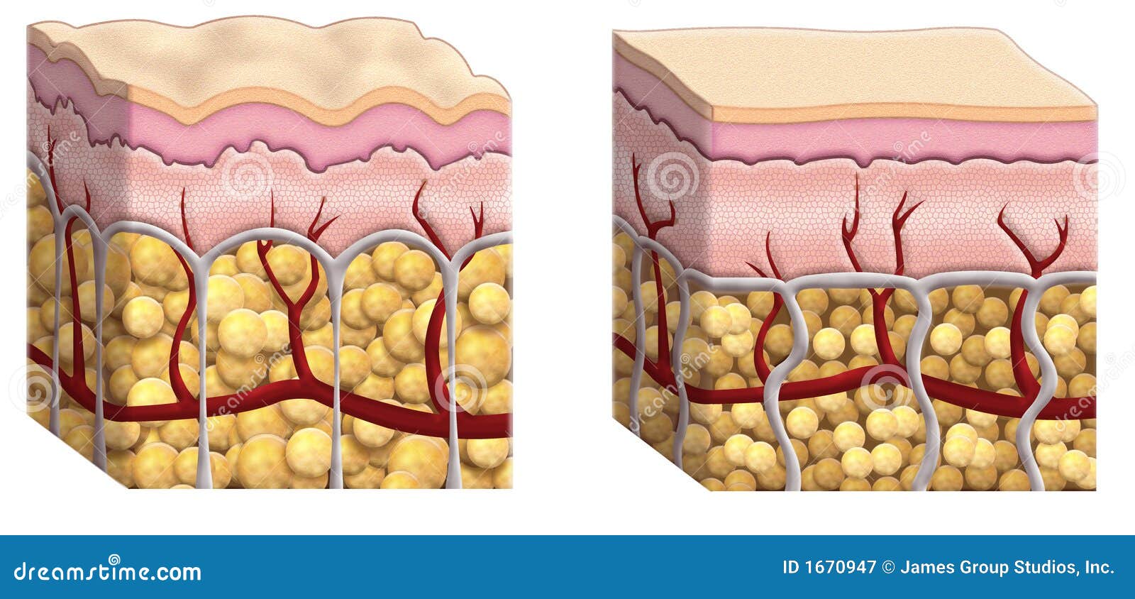 Section Transversale De Cellulites Illustration Stock - Illustration du ...