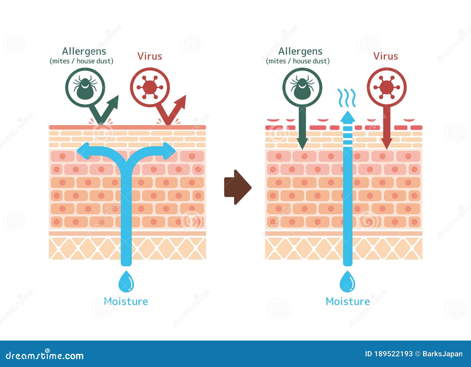 Sectional View of Atopic Dermatitis and Normal Skin / Comparative ...
