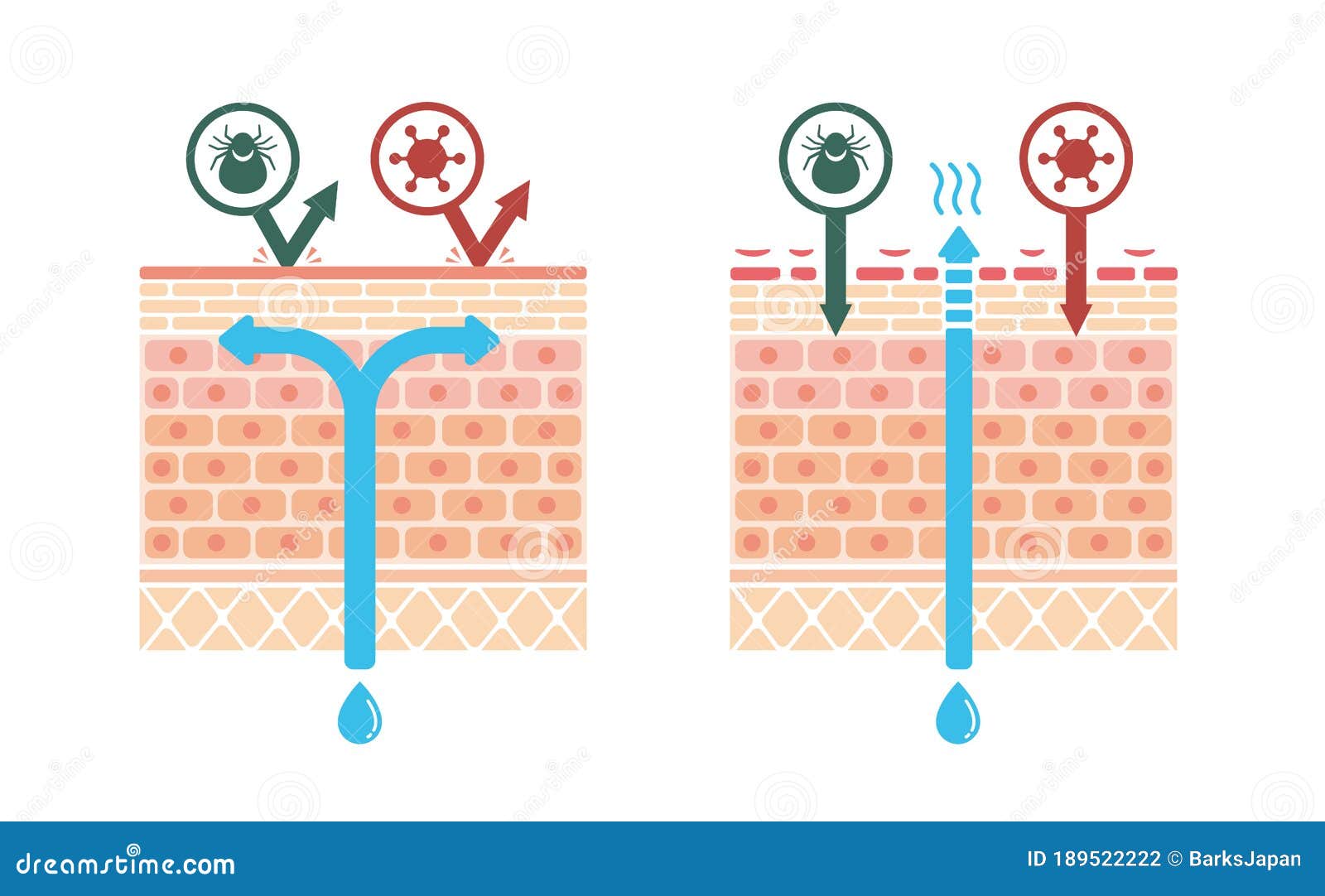 Sectional View of Atopic Dermatitis and Normal Skin / Comparative ...