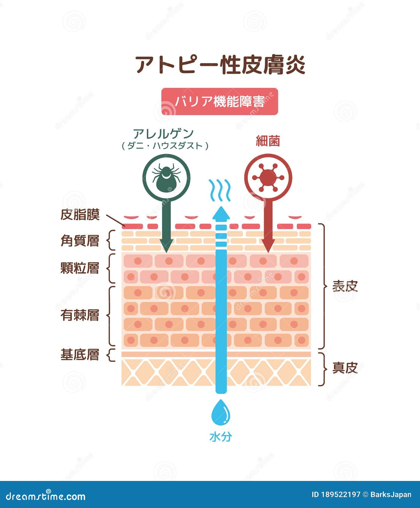 Sectional View of Atopic Dermatitis / Vector Illustration Stock Vector ...
