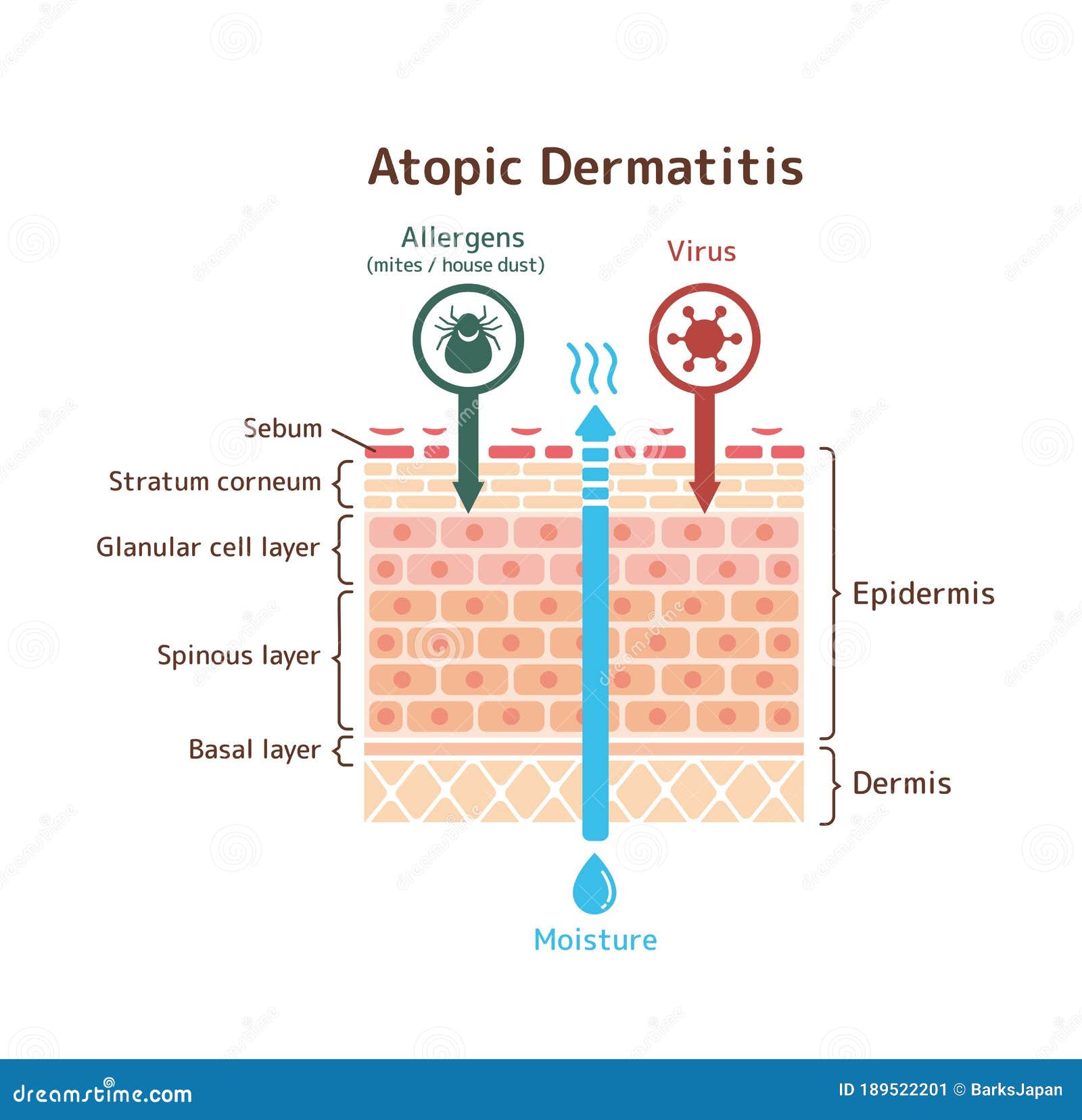 Sectional View of Atopic Dermatitis / Vector Illustration Stock Vector ...