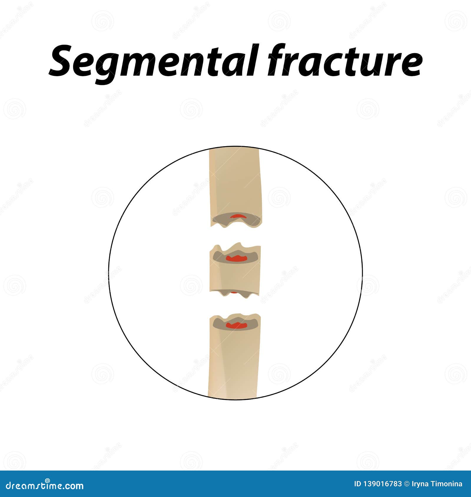 Segmental Fracture Bone. Infographics. Vector Illustration On A Lined ...