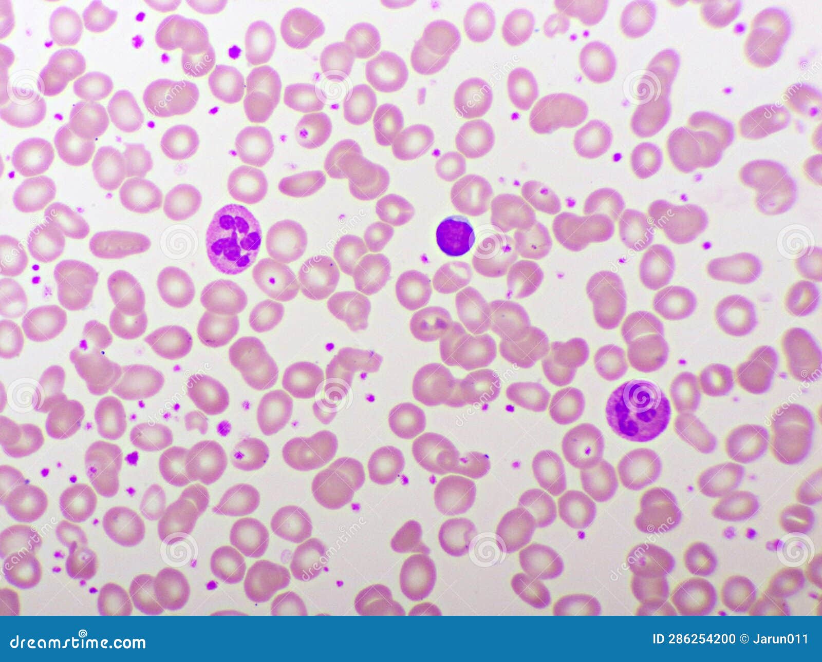 Segmented Neutrophil Cell in Human Blood Smear Stock Photo - Image of ...
