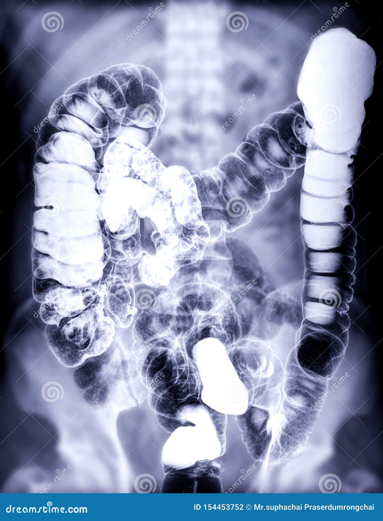 Selective Focus of Barium Enema Stock Photo - Image of demonstrated ...