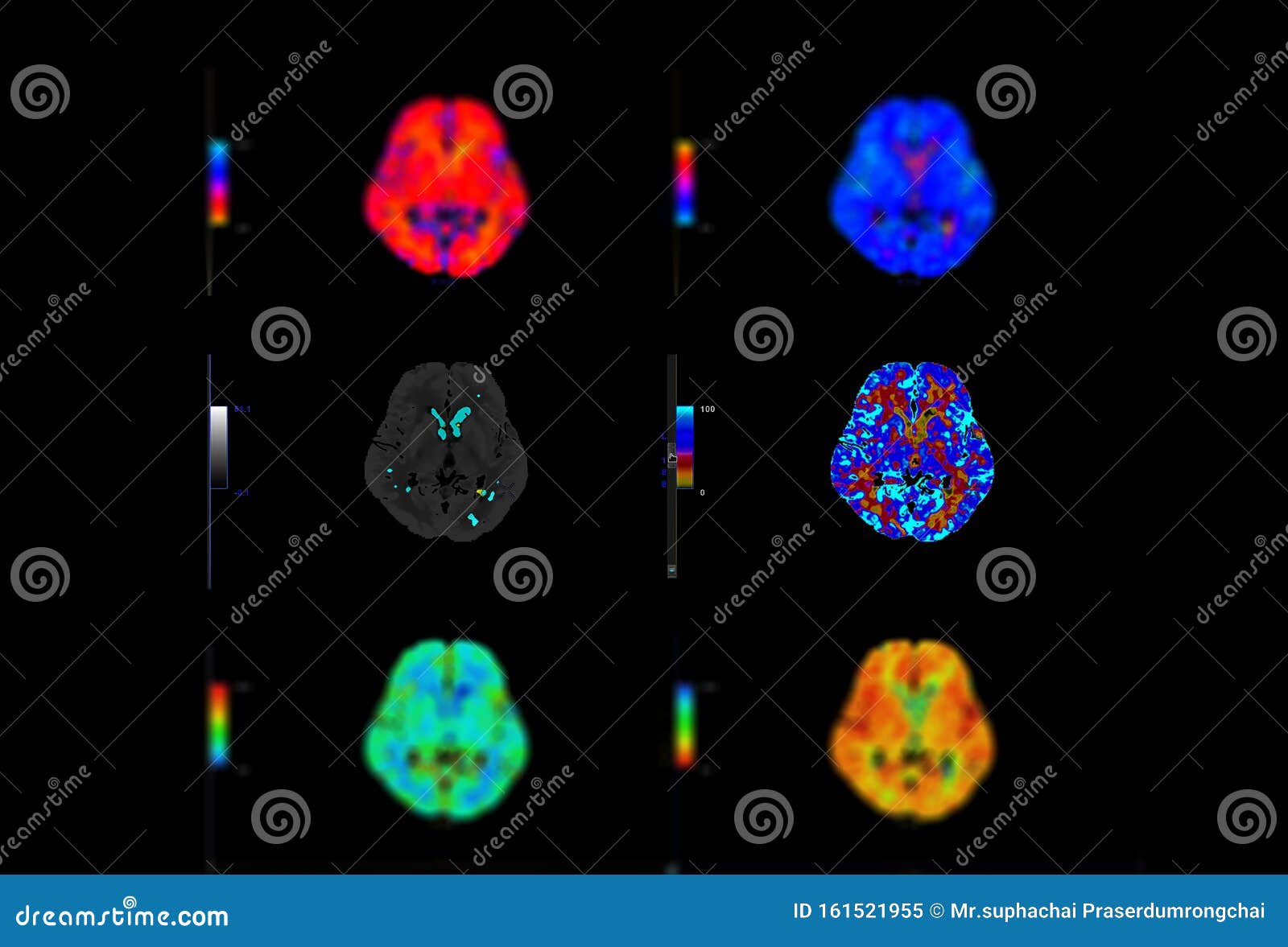 Brain Perfusion Or CT Scan Of Blood Flow In The Brain 3d Rendering ...