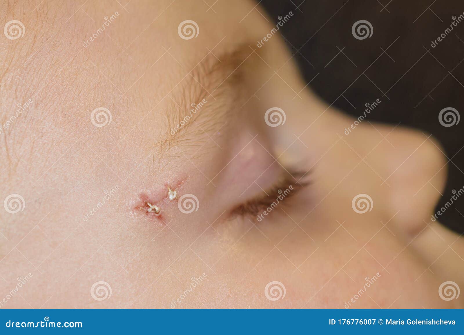 Surgical Sutures Applied To The Skin After Surgery Royalty-Free Stock ...