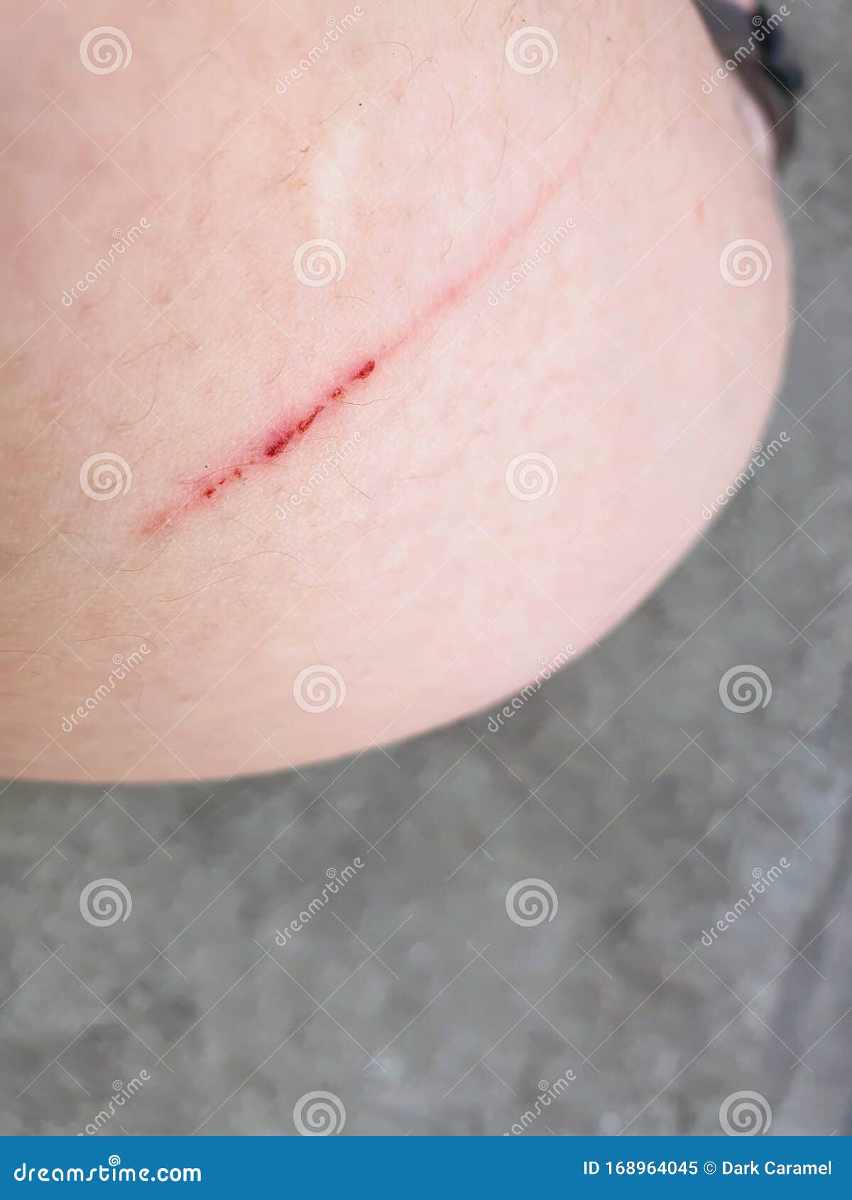 Selective Focus of Wounds from Sharp Objects on Human Skin As a ...
