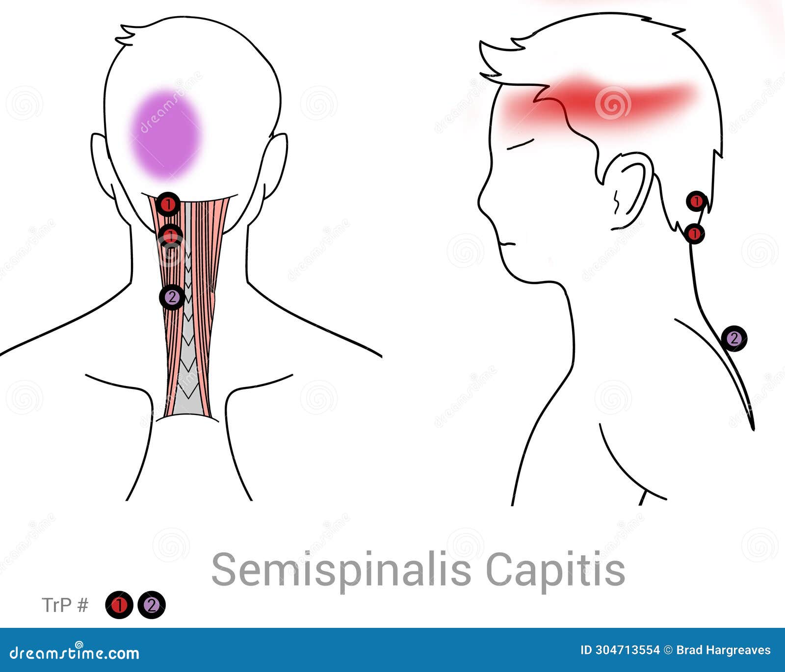 Semispinalis Capitis Trigger Points Can Cause Pain in the Back and Side ...