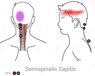 Semispinalis Capitis Trigger Points Can Cause Pain in the Back and Side ...