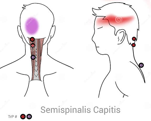 Semispinalis Capitis Trigger Points Can Cause Pain in the Back and Side ...