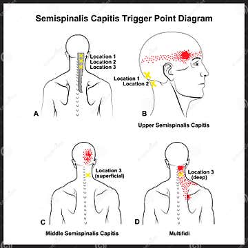 Semispinalis Capitis Trigger Point Diagram Stock Vector - Illustration ...