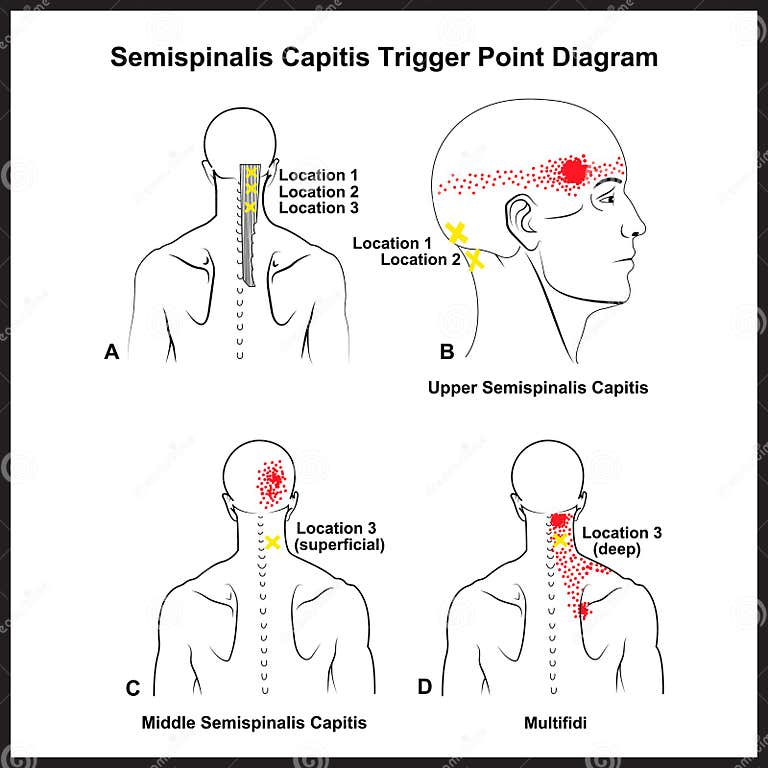 Semispinalis Capitis Trigger Point Diagram Stock Vector - Illustration ...