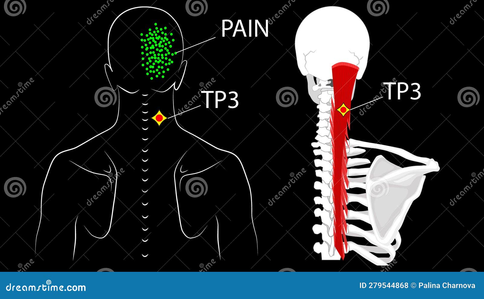 Splenius Capitis Trigger Points Splenius Capitis Trigger Points