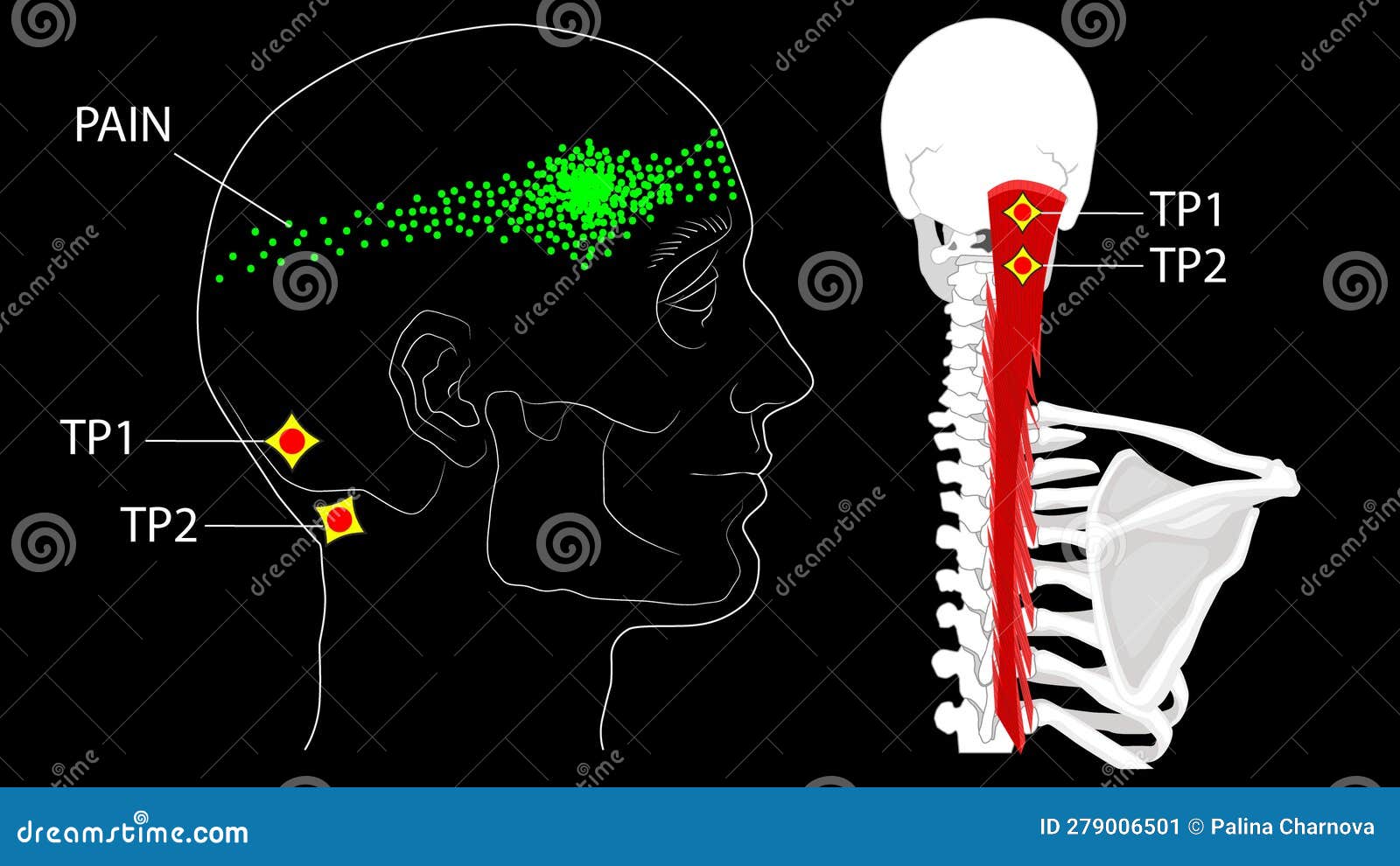 Semispinalis Muscles. Trigger Points and Referred Pain Stock ...