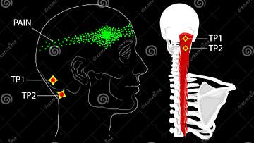 Semispinalis Muscles. Trigger Points and Referred Pain Stock ...