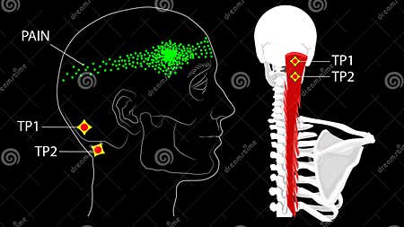 Semispinalis Muscles. Trigger Points and Referred Pain Stock ...