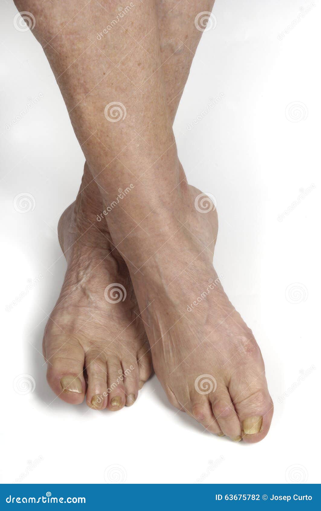 Senior woman feet stock photo. Image of osteoarthritis - 63675782