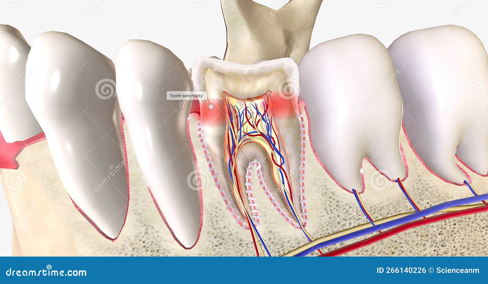 Sensitive Teeth is a Common Dental Condition Characterized by Sharp ...