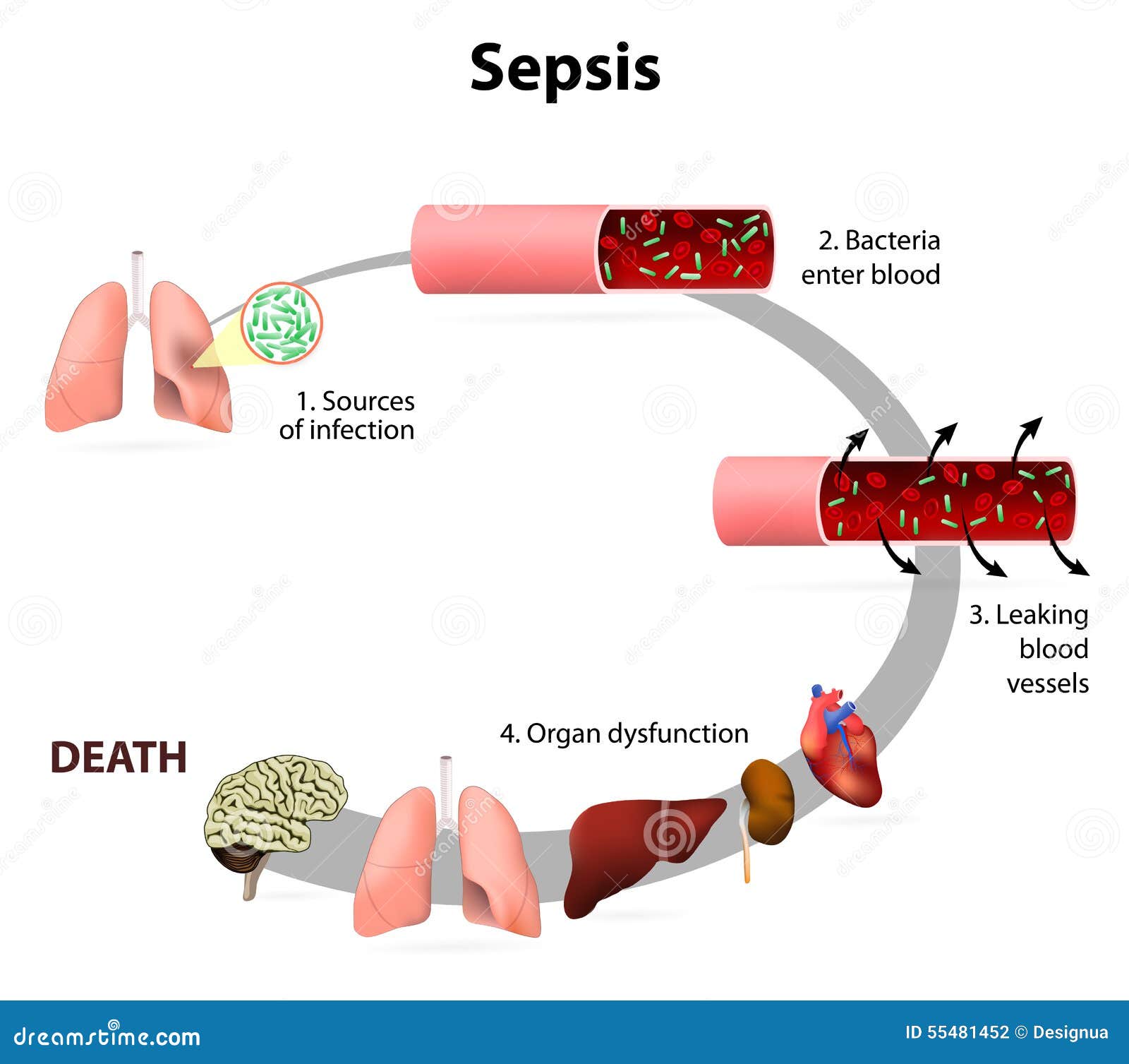Sepsis vektor abbildung. Illustration von arthritis, bakterium - 55481452