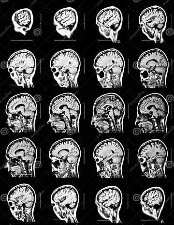 Sequence of Vertical Sections of a Human Brain Stock Photo - Image of ...