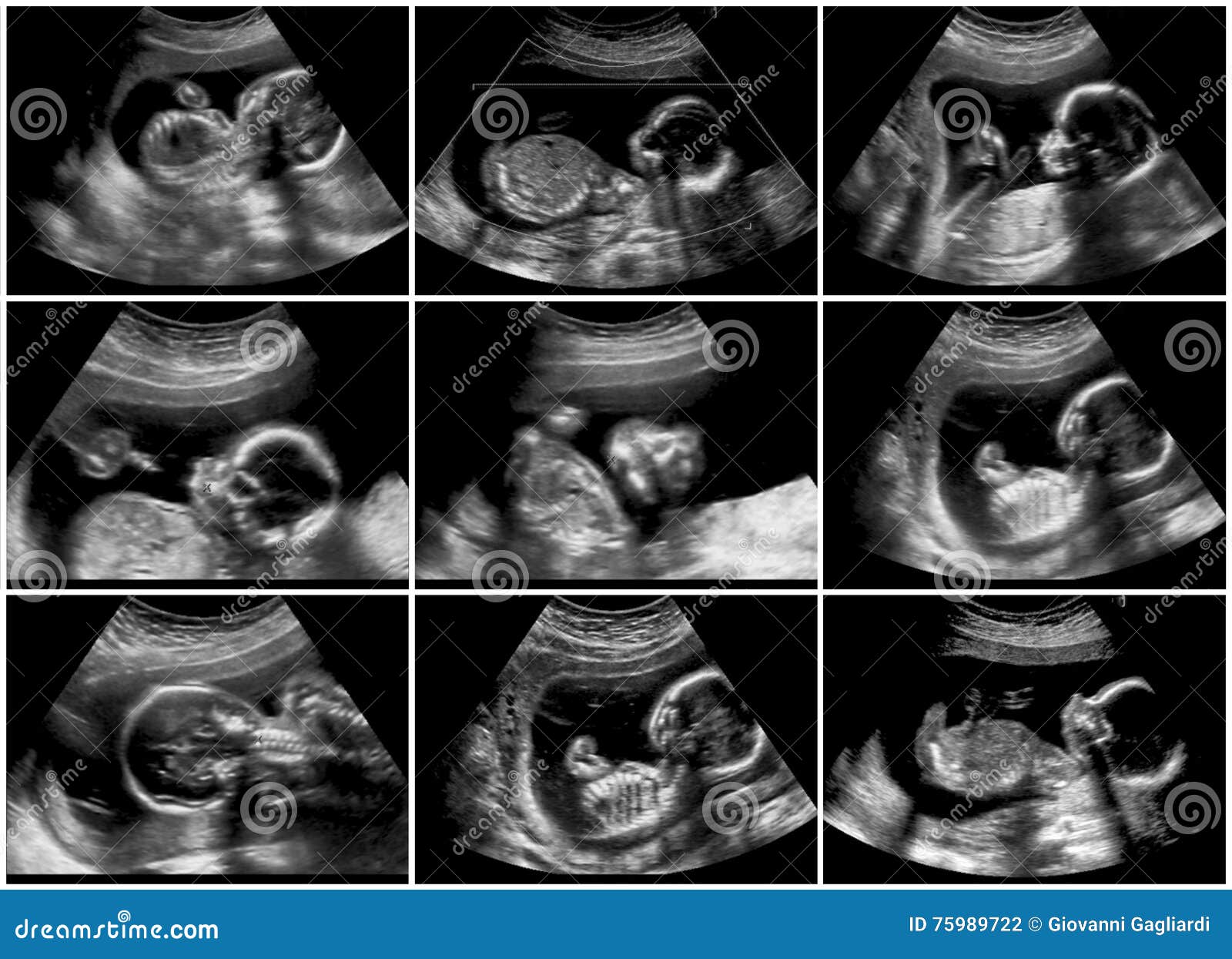 20 Week Fetus Ultrasound