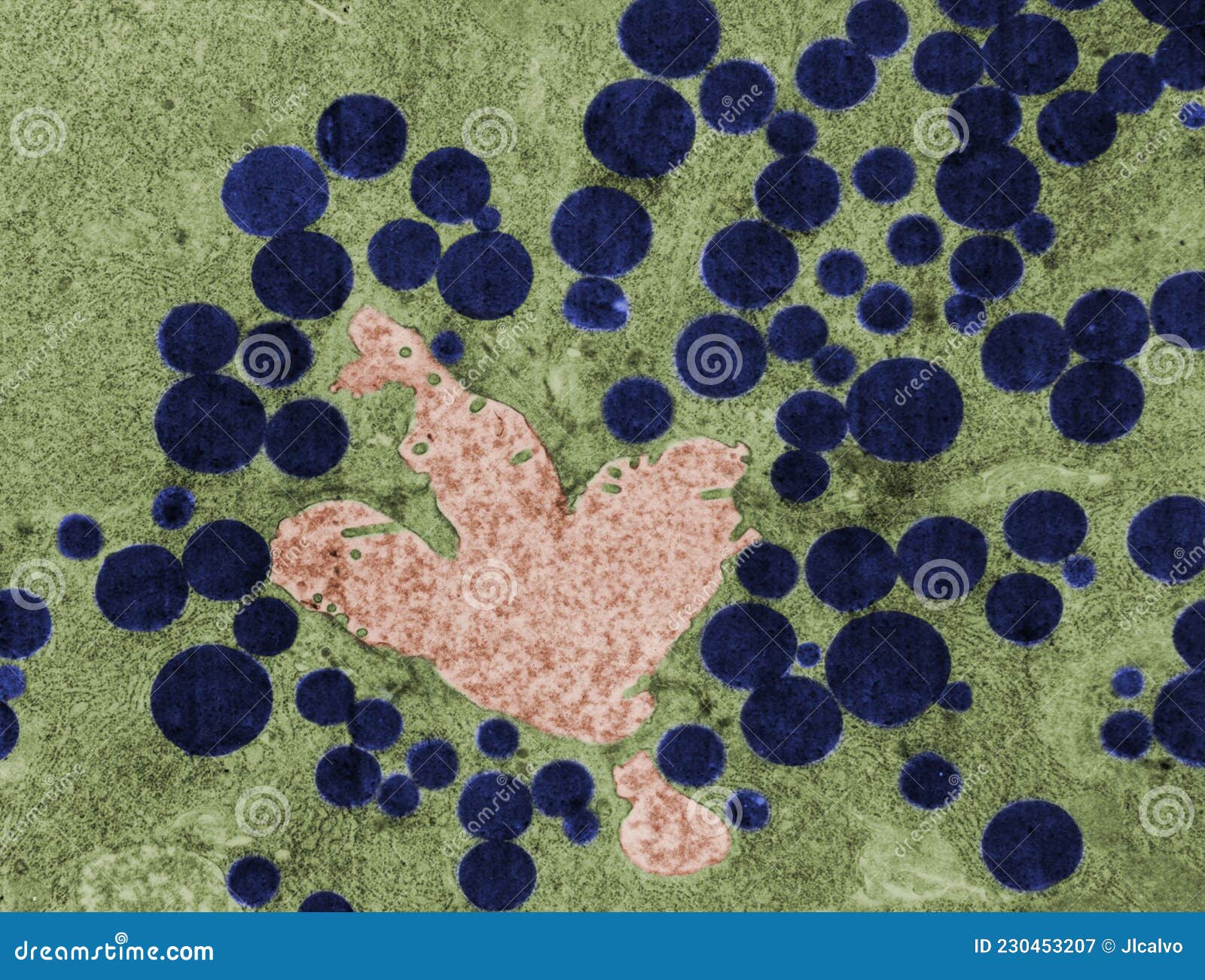 Two-lumen Central Venous Catheter For Dialysis Patient With Kidney ...