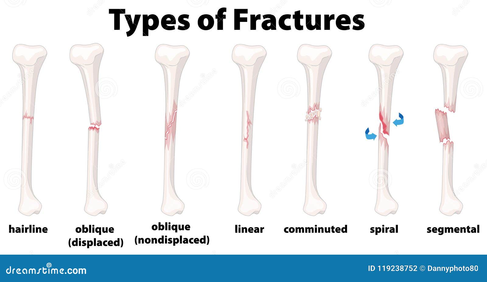 A Set of Bone Fractures stock vector. Illustration of drawing - 119238752 A Set of Bone Fractures stock vector. Illustration of drawing - 119238752