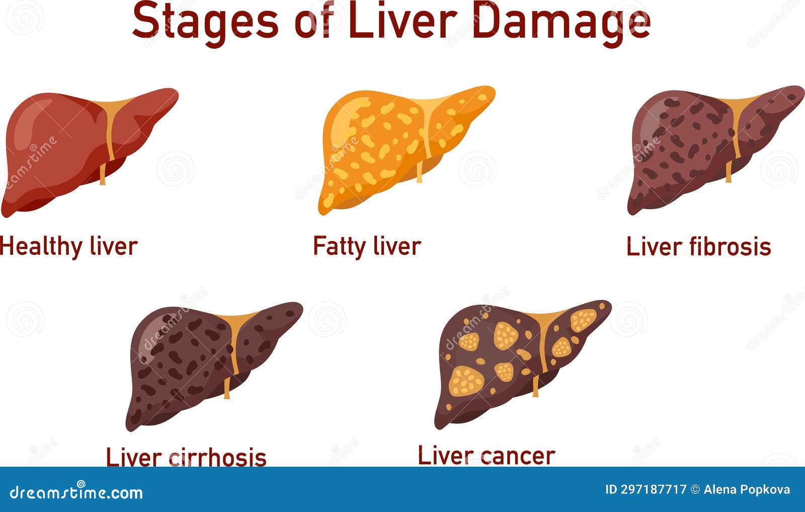 Stages Of Liver Damage. The First Symptoms Of Liver Problems Are ...