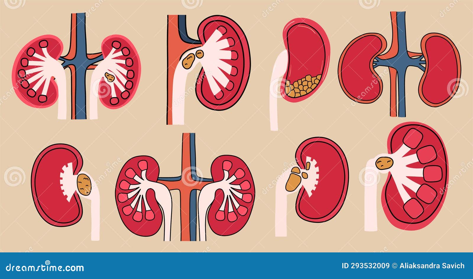 A Set of Kidneys with Stones Inside. Vector Illustration in Flat Style ...