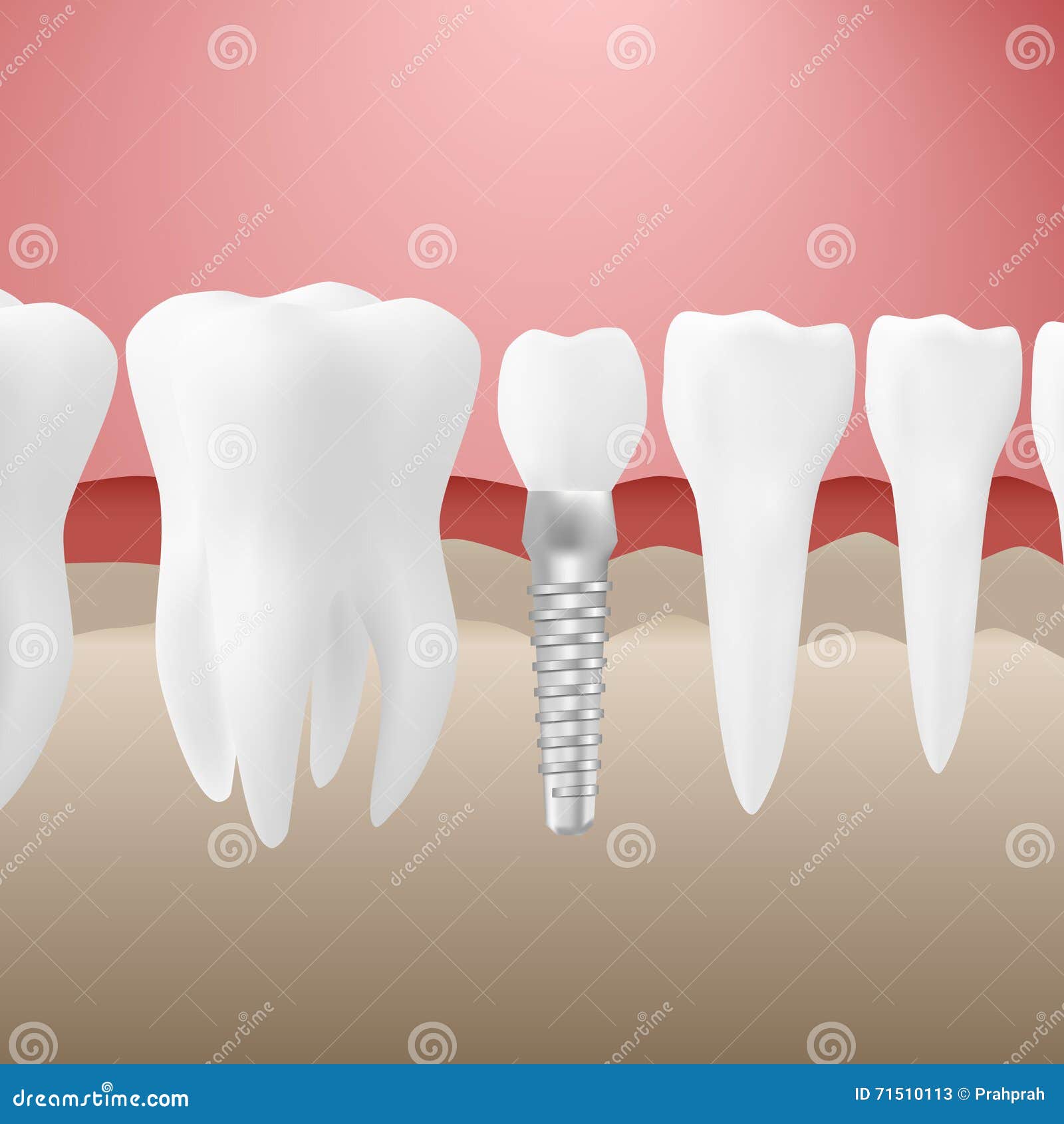 Set of tree tooth stock illustration. Illustration of stomatology ...
