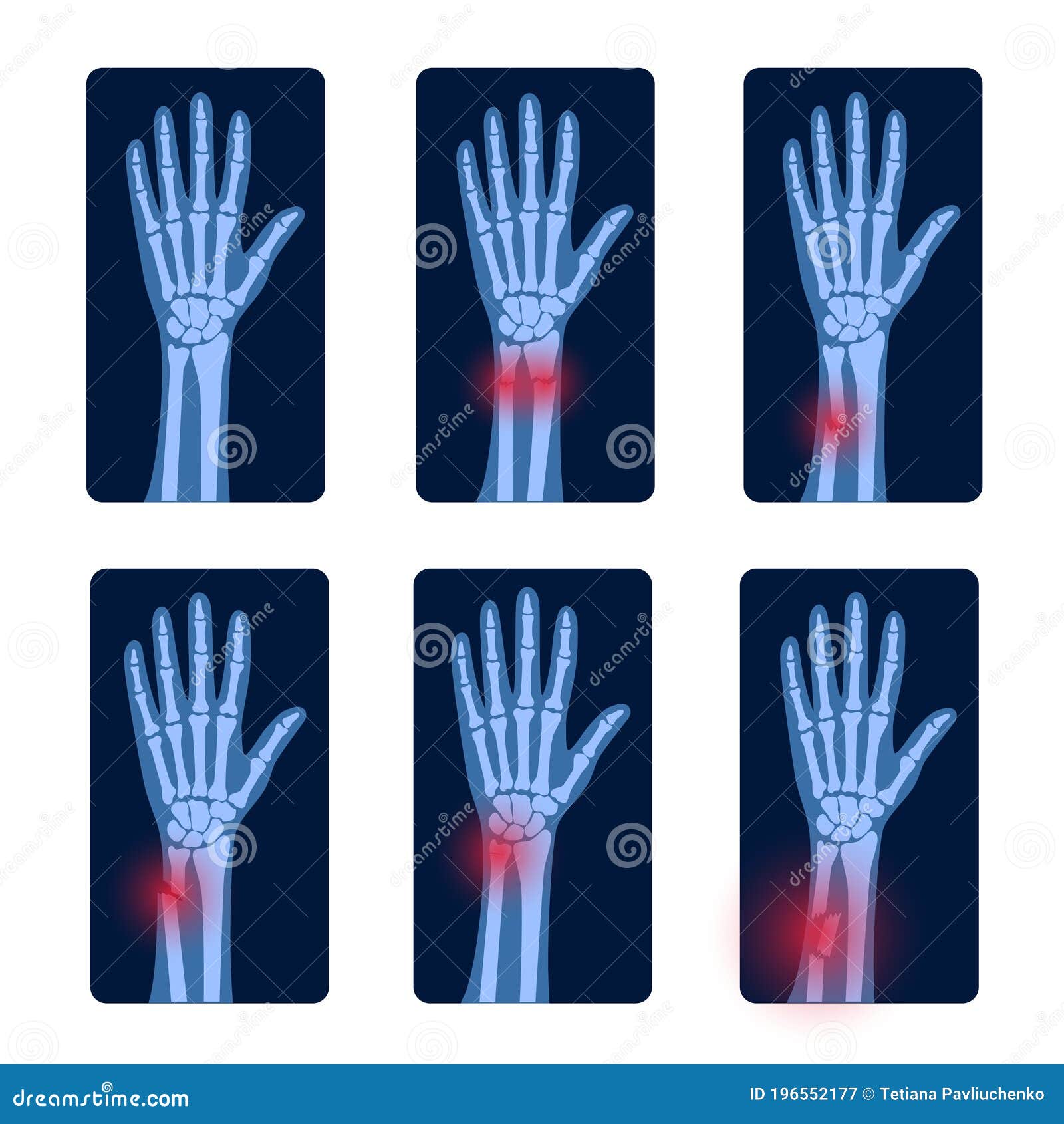 Distal, Normal, And Mesial Bite Profile, Vector Illustration. Overbite ...
