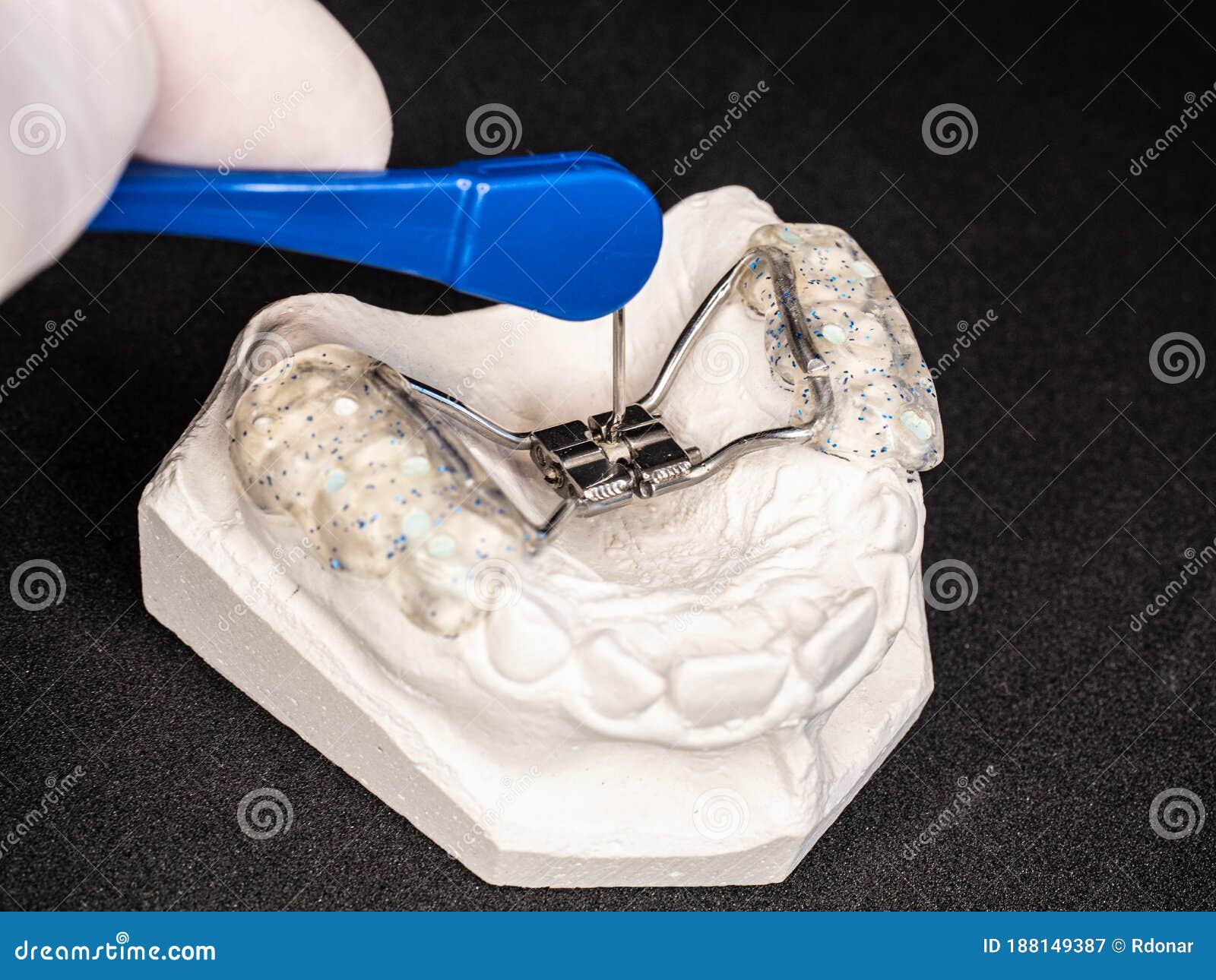 Setting of Braces with Expansion on Teeth Stock Image - Image of gloves ...