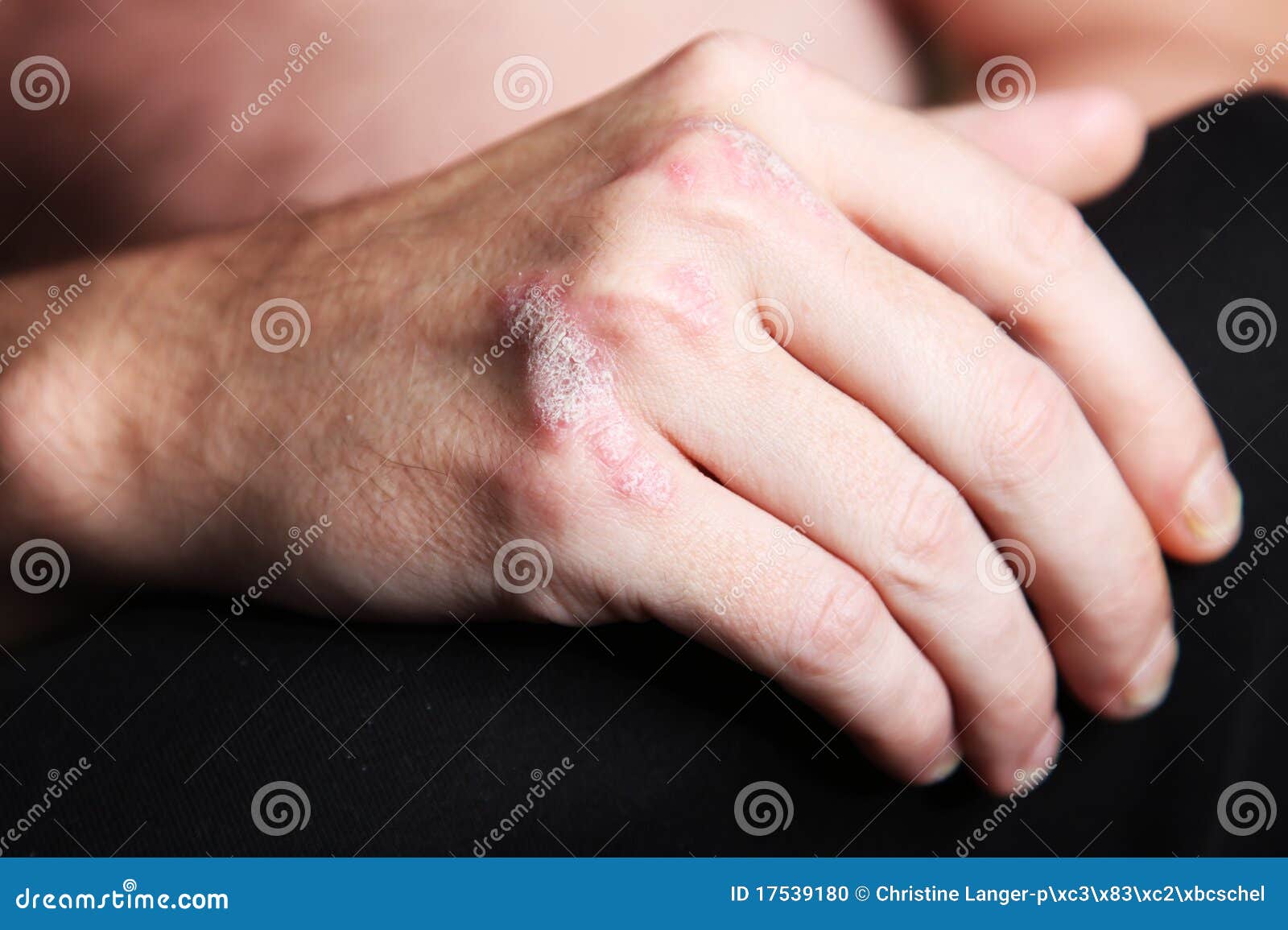 Severe Psoriasis - Psoriasis on the Hand Stock Photo - Image of health ...