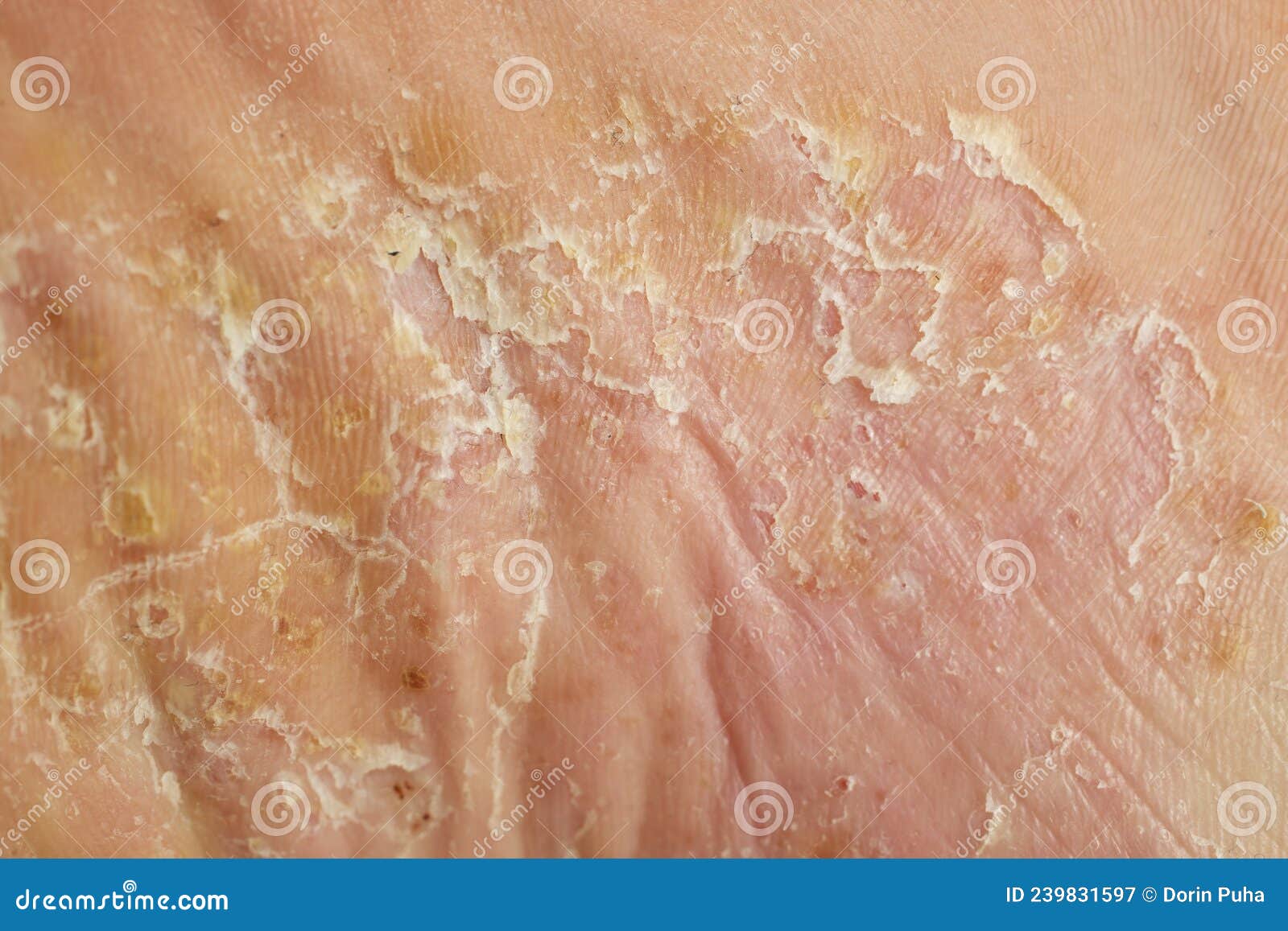 Severe Pustular Psoriasis Lesions on the Sole of the Foot Stock Image ...