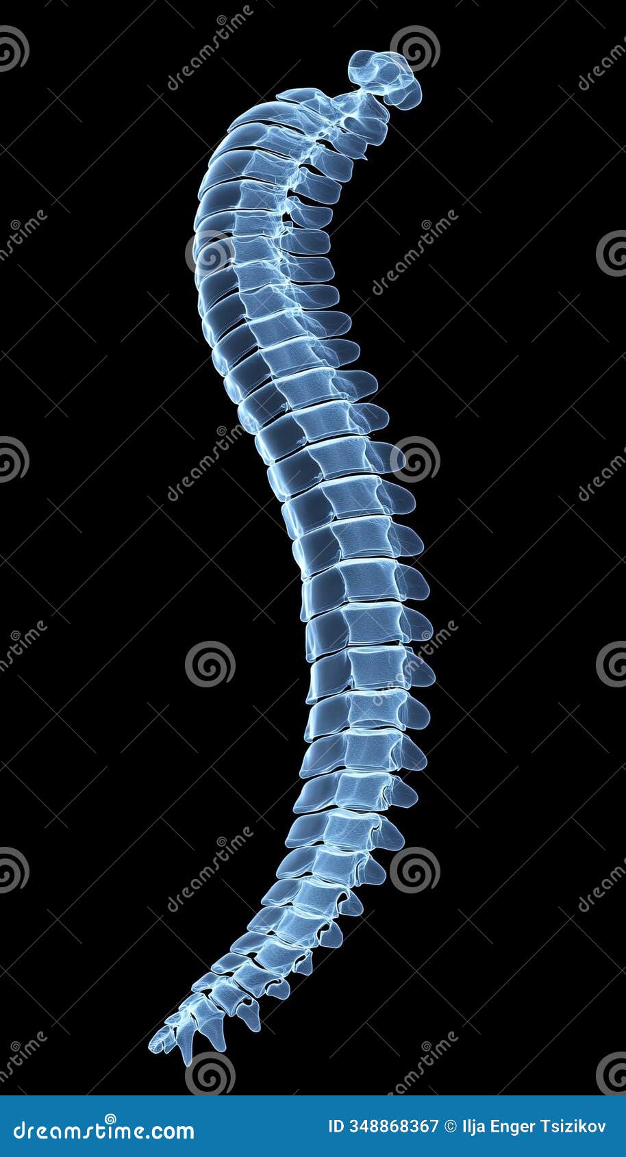 Severe Spinal Degeneration, X-ray Visualization with Reduced Disc ...