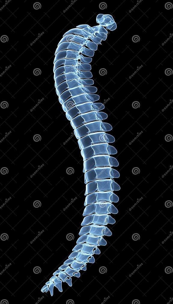 Severe Spinal Degeneration, X-ray Visualization with Reduced Disc ...